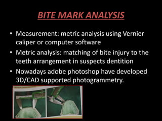 Bite Marks (FORENSIC DENTISTRY) | PPTX