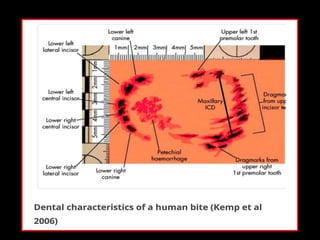 Bite Marks (FORENSIC DENTISTRY) | PPTX