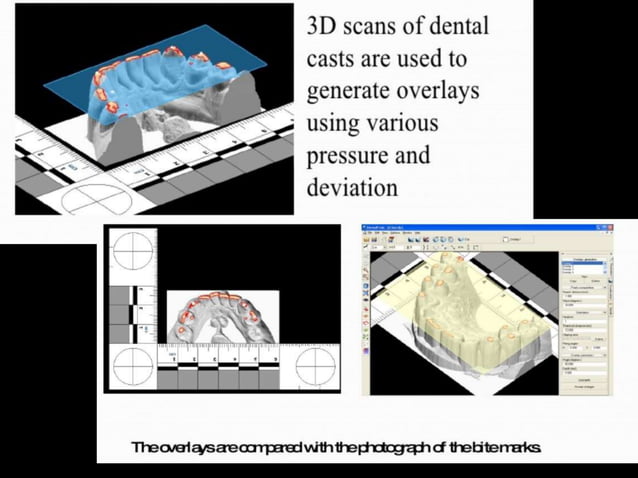 Bite Marks (FORENSIC DENTISTRY) | PPTX