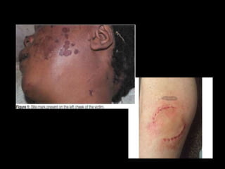 Bite Marks (FORENSIC DENTISTRY) | PPTX