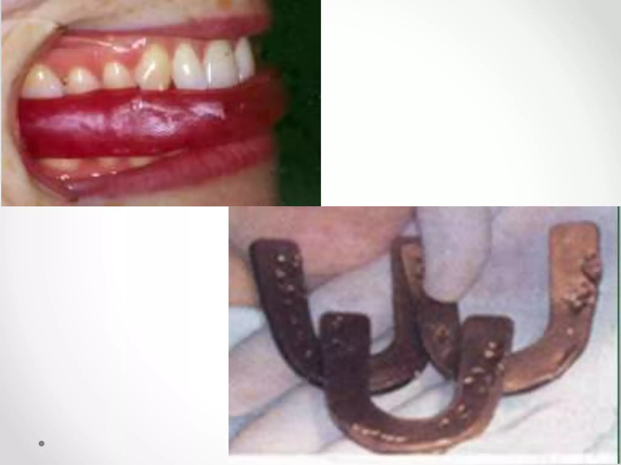 bite registeration.pptx