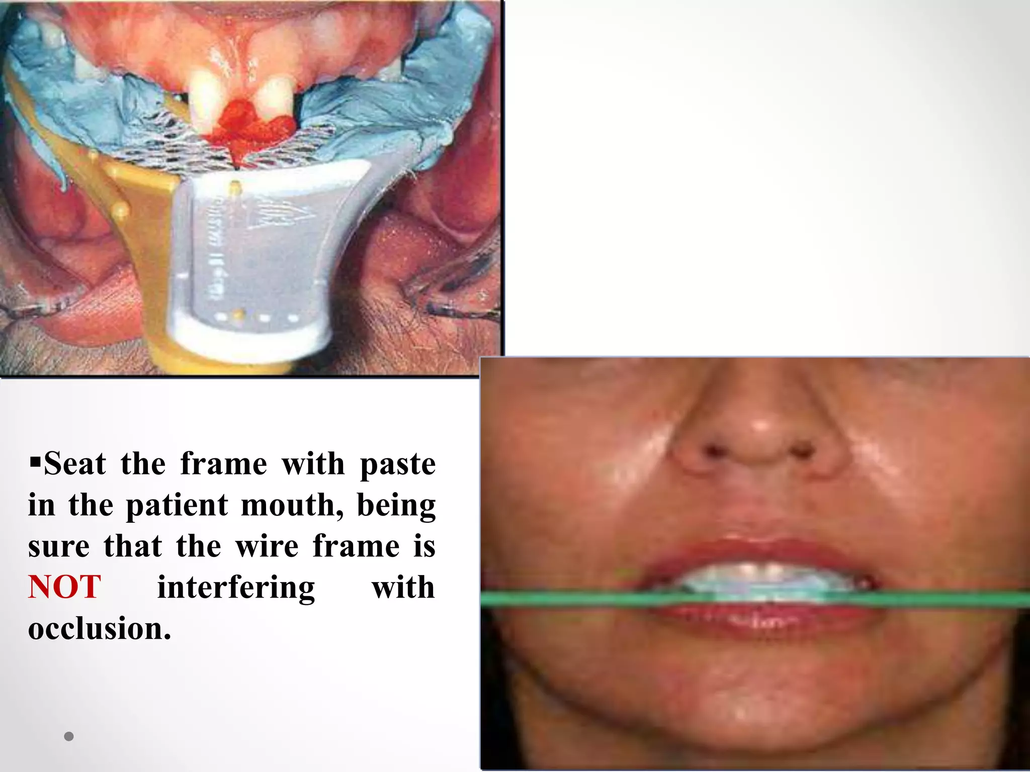bite registeration.pptx