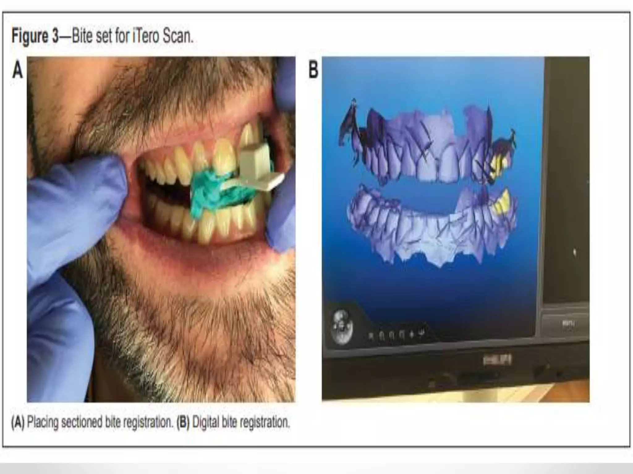 bite registeration.pptx