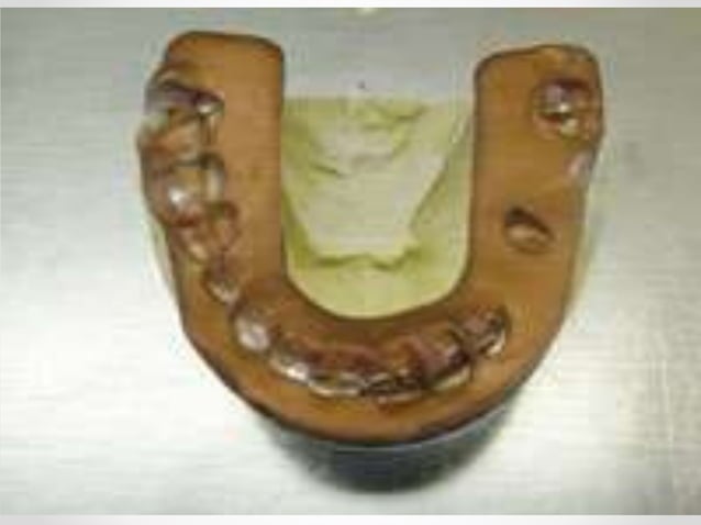 bite registeration.pptx