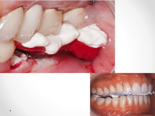 bite registeration.pptx