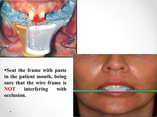 bite registeration.pptx
