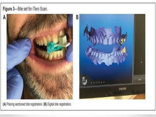 bite registeration.pptx