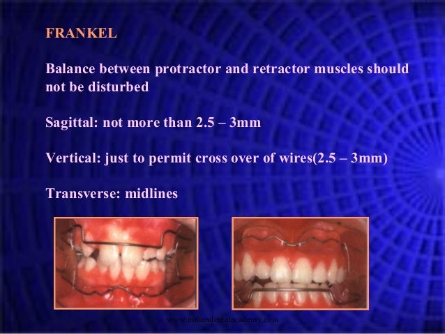 Bite Registration In Functional Appliances