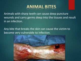 BITES AND STINGS.pptx