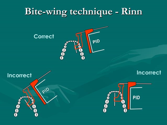 Bite-wing and technique errors lecture1 | PPT