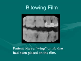Bite-wing and technique errors lecture1 | PPT