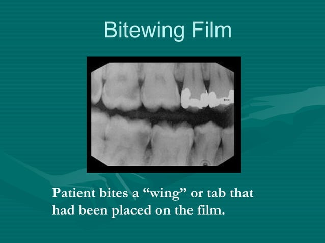 Bite-wing and technique errors lecture1 | PPT