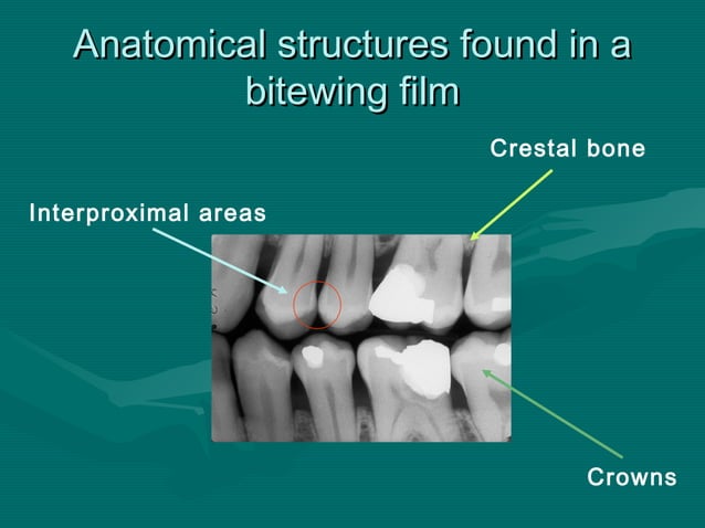 Bite-wing and technique errors lecture1 | PPT
