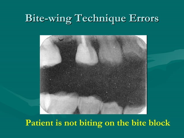Bite-wing and technique errors lecture1 | PPT