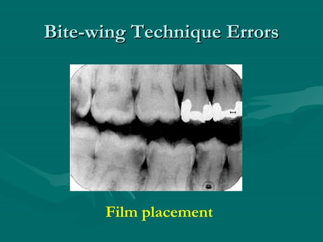 Bite-wing and technique errors lecture1 | PPT