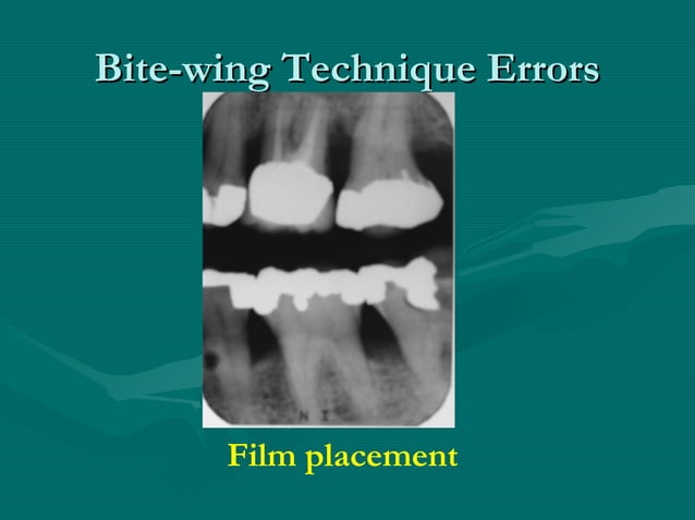 Bite-wing and technique errors lecture1 | PPT