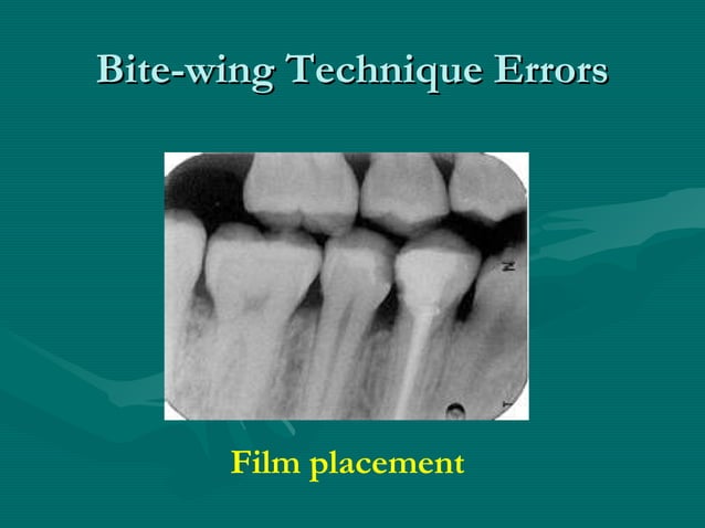 Bite-wing and technique errors lecture1 | PPT