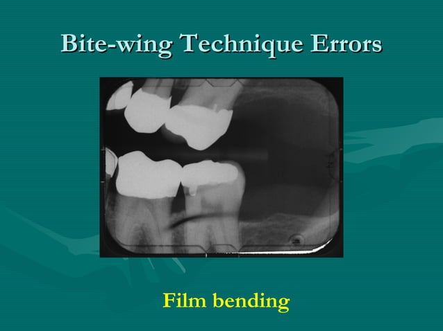 Bite-wing and technique errors lecture1 | PPT