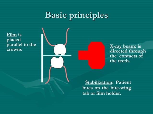 Bite-wing and technique errors lecture1 | PPT
