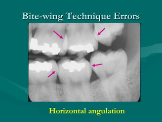 Bite-wing and technique errors lecture1 | PPT