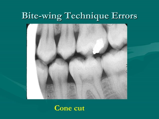 Bite-wing and technique errors lecture1
