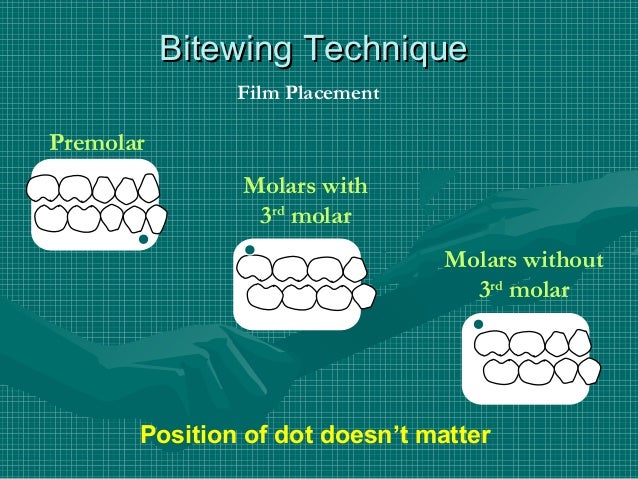 Bite-wing and technique errors lecture1