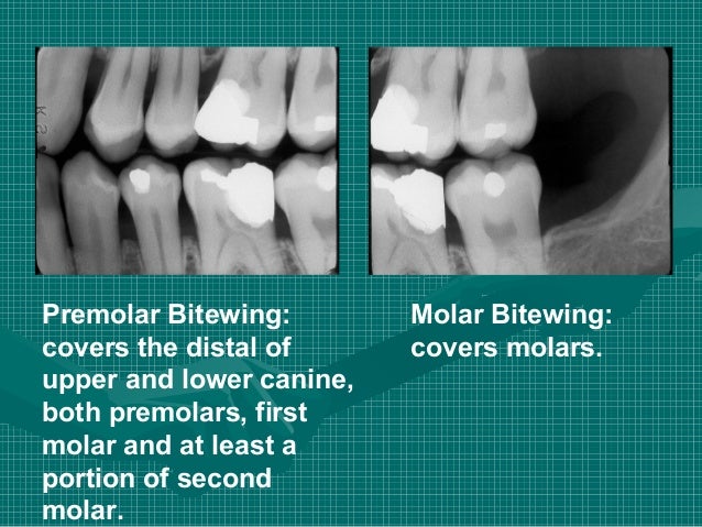 Bite-wing and technique errors lecture1