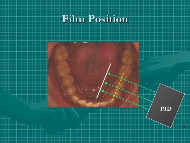 Bite-wing and technique errors lecture1