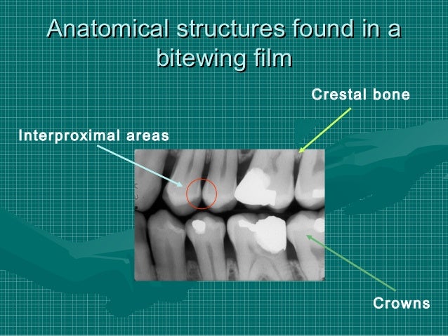 Bite-wing and technique errors lecture1