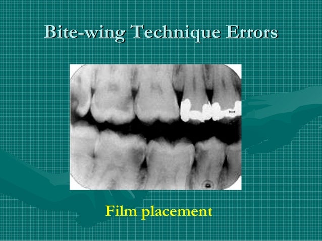 Bite-wing and technique errors lecture1