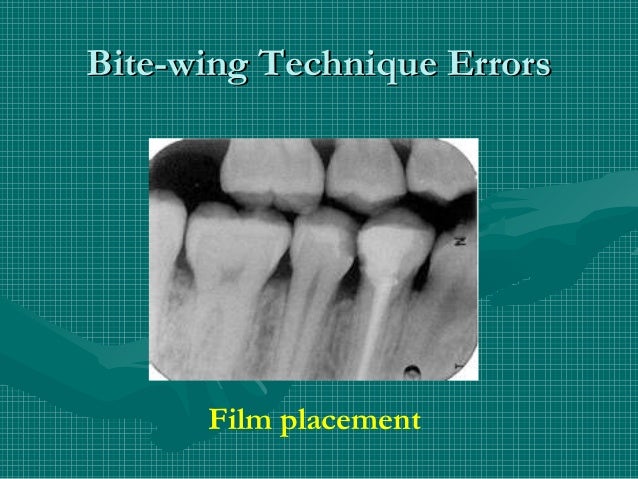 Bite-wing and technique errors lecture1