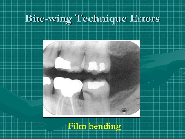 Bite-wing and technique errors lecture1