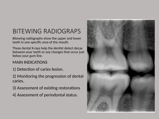 bitewing rad.pptx, definition, techniques | PPTX