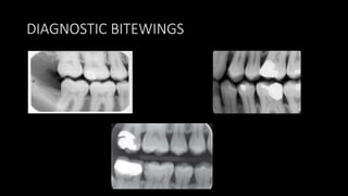Dental radiology-BITEWING RADIOGRAPHY - Copy.pptx