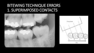 Dental radiology-BITEWING RADIOGRAPHY - Copy.pptx