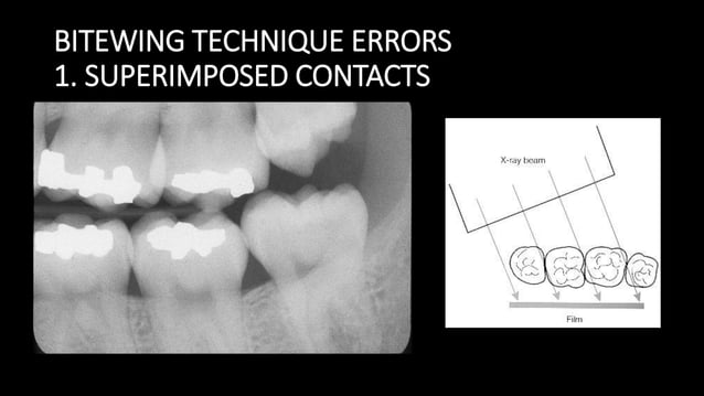 Dental radiology-BITEWING RADIOGRAPHY - Copy.pptx