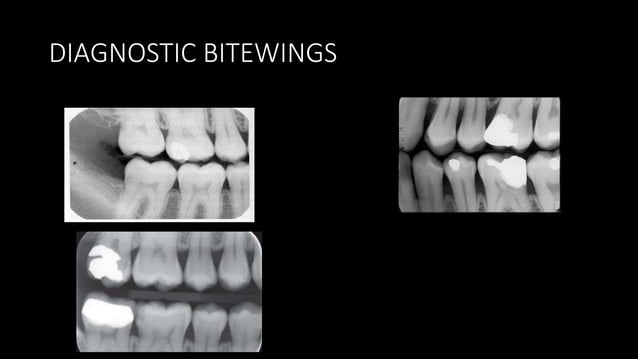 Dental radiology-BITEWING RADIOGRAPHY - Copy.pptx