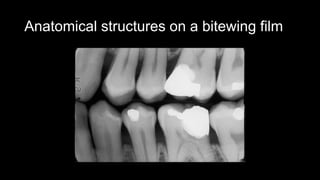 Dental radiology-BITEWING RADIOGRAPHY - Copy.pptx