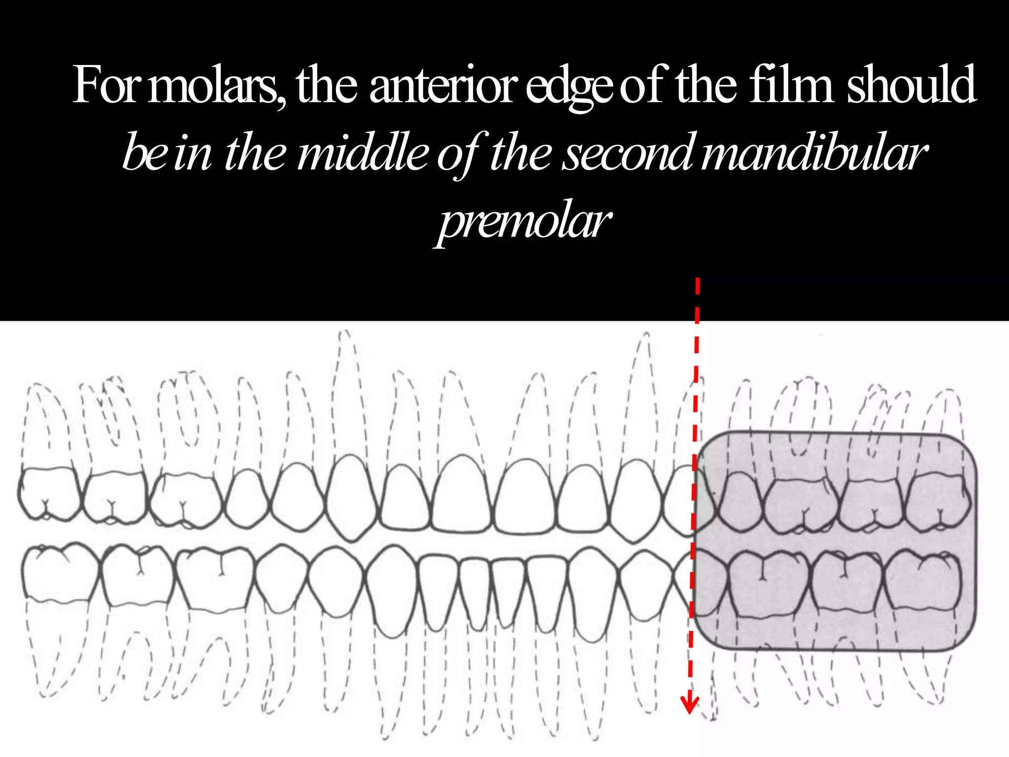 Bitewing Technique.pptx