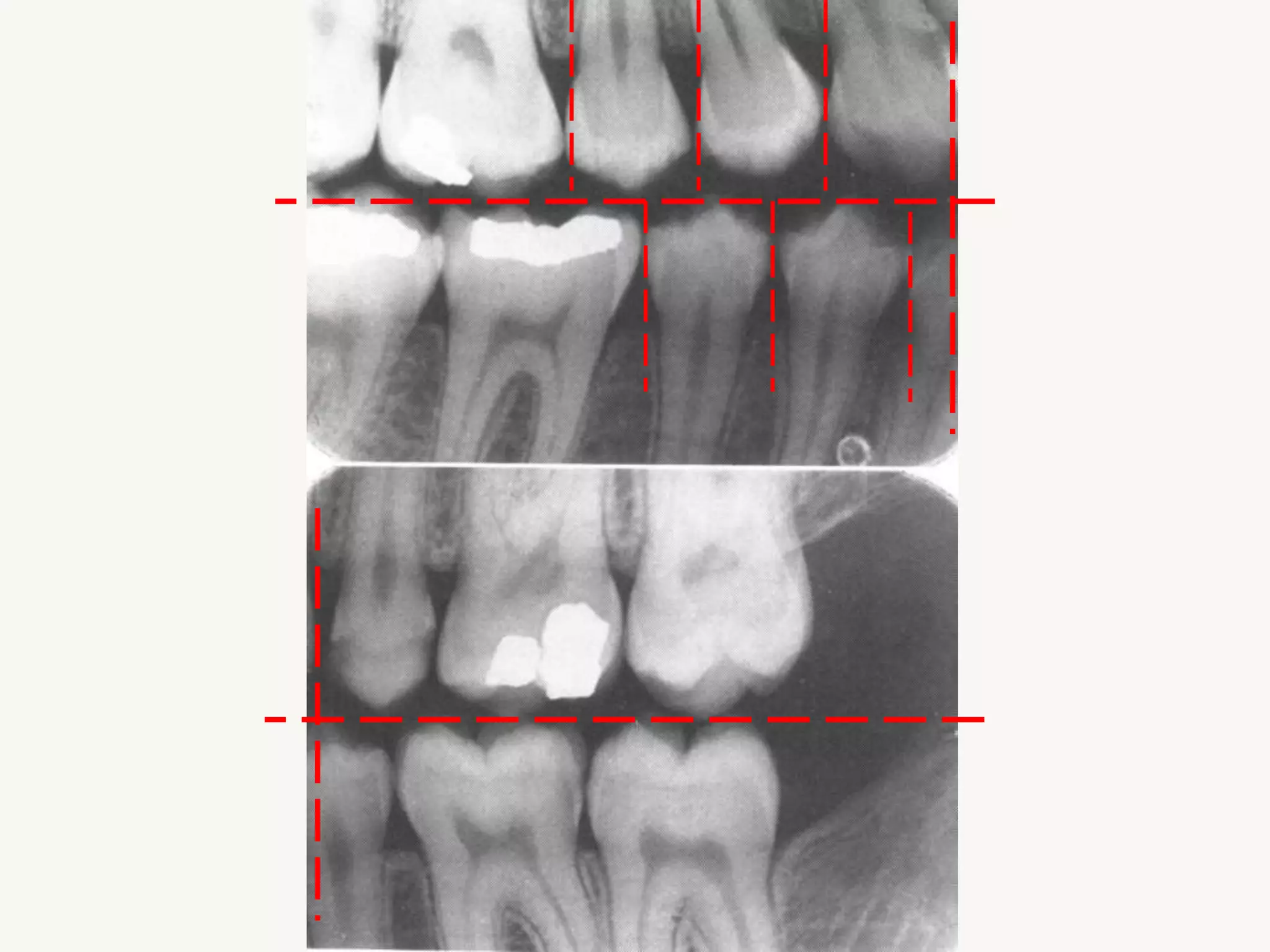 Bitewing Technique.pptx