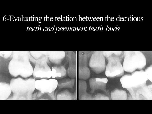 Bitewing Technique.pptx