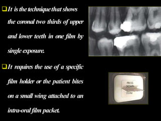 Bitewing Technique.pptx