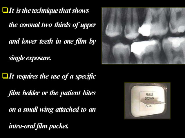 Bitewing Technique.pptx