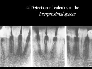 Bitewing Technique.pptx
