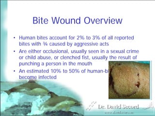 Bite Wound Lecture | PDF