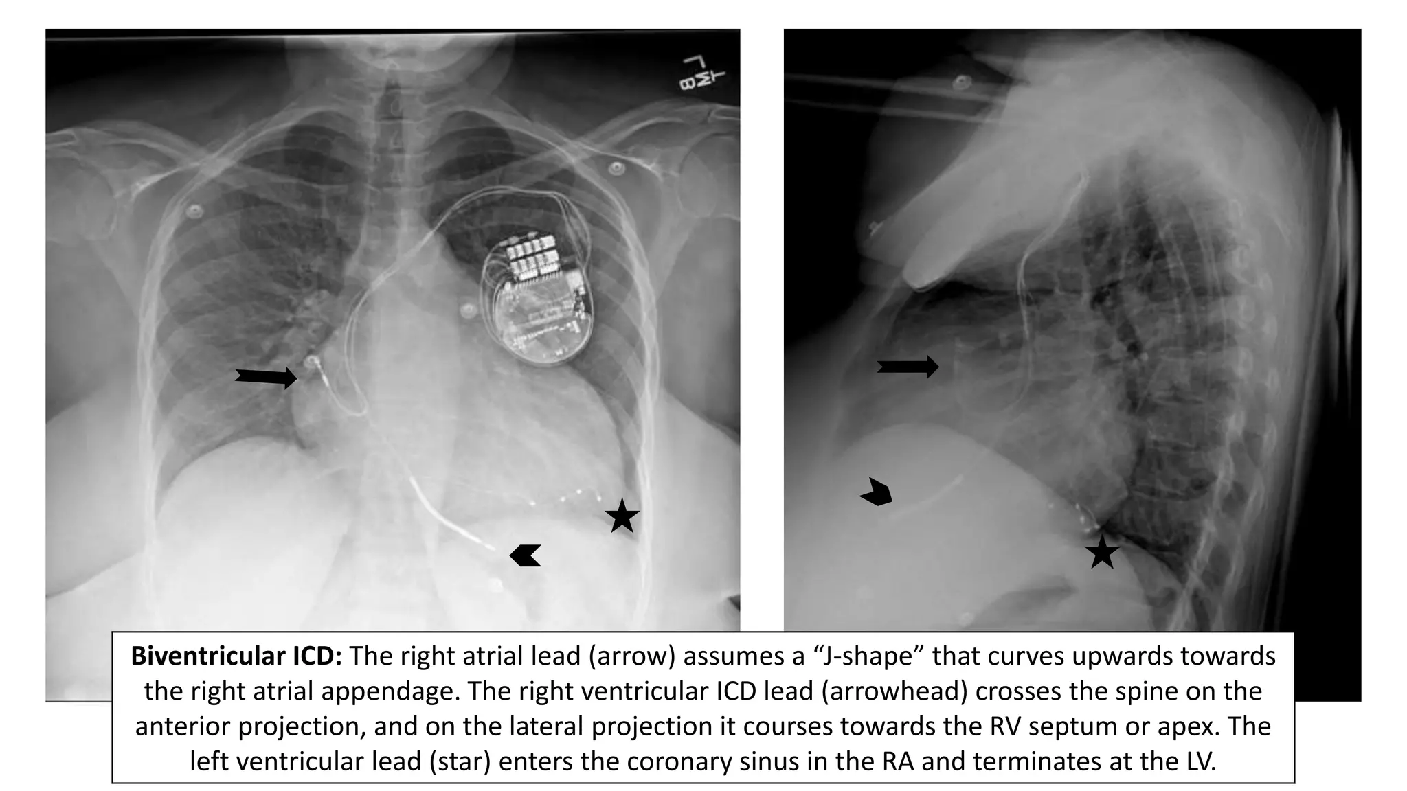 Dr. Cravens CMC Implanted Device Imaging Mastery Project: BiVentricular ...