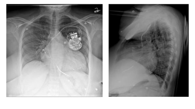Dr. Cravens CMC Implanted Device Imaging Mastery Project: BiVentricular ...