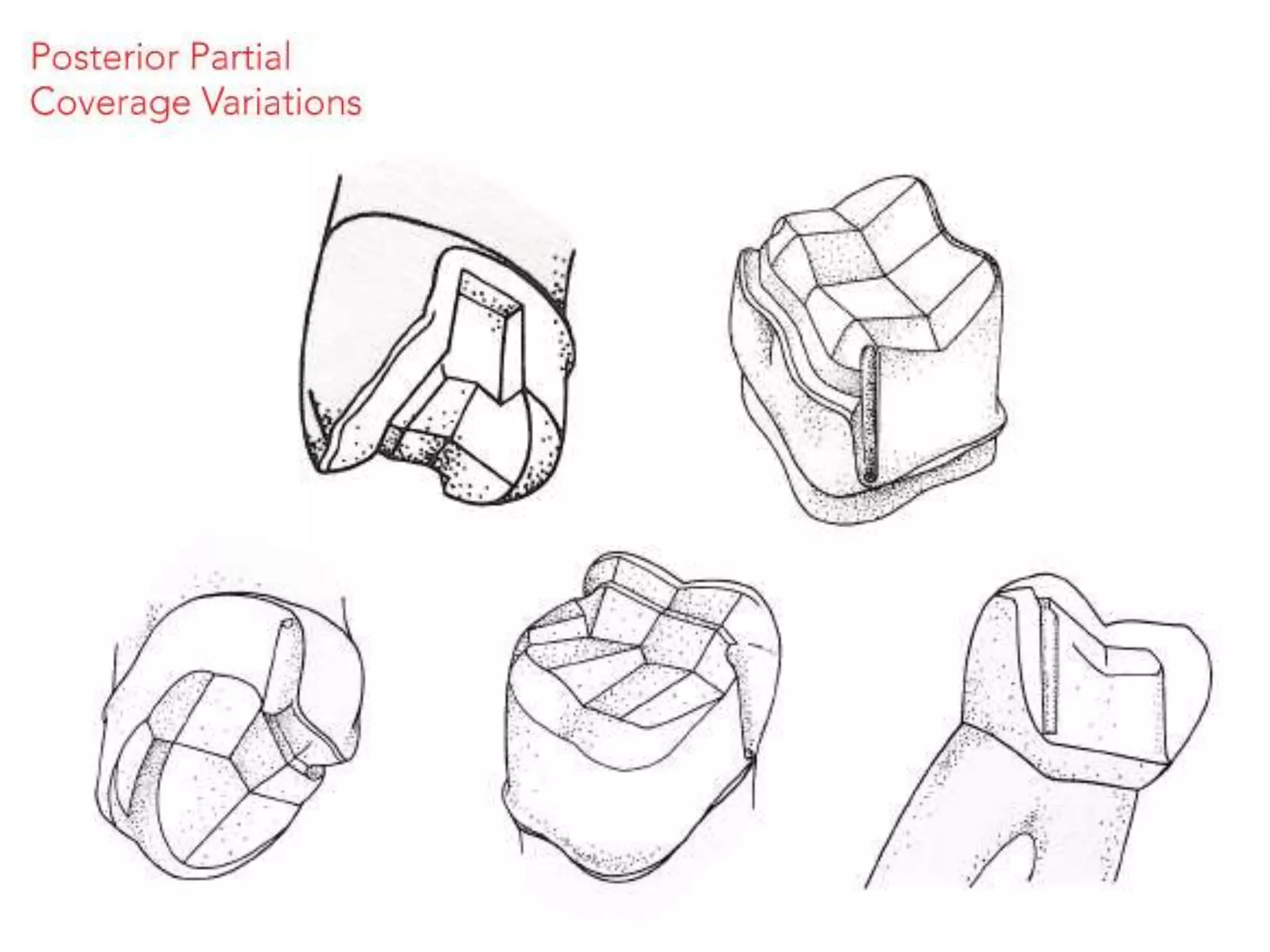 preparation for partial coverage crowns | PPTX
