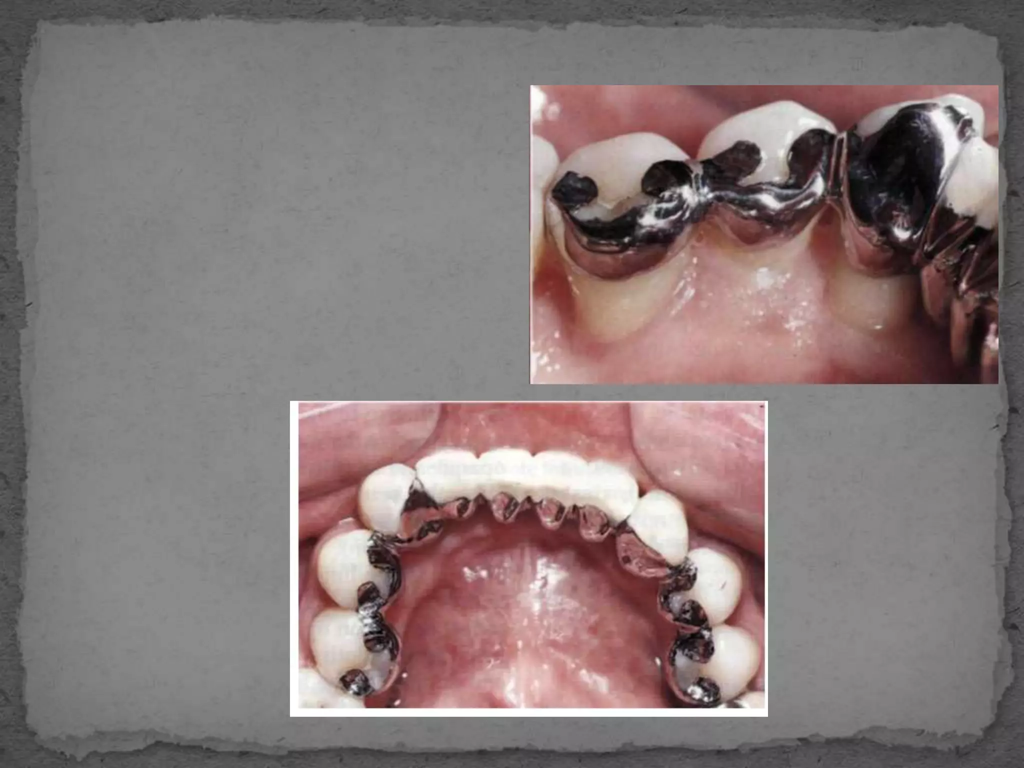 preparation for partial coverage crowns | PPTX