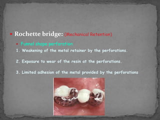 preparation for partial coverage crowns | PPTX